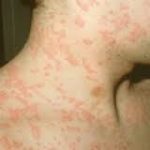 Syndicat national des dermatologues-vénéréologues